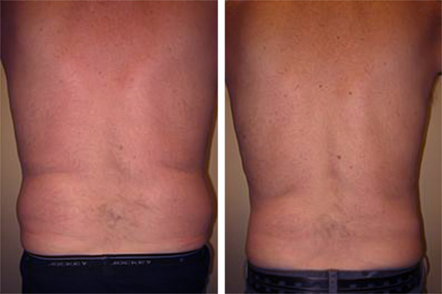 Smart Lipo Before and After Pictures