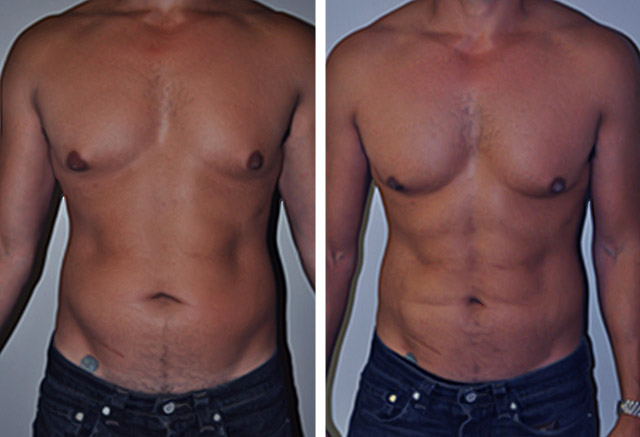 Smart Lipo Before and After Pictures