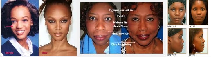 Plastic Surgery for Ethnic Patients - SmartLipo Blog